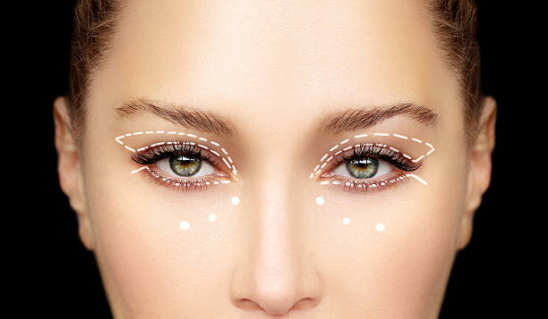 Recovery after Eyelid Surgery or Bleph - Dr Michael Kernohan in Sydney