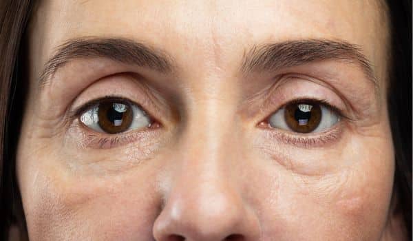 Solutions for Sunken Eyes - Dr Michael Kernohan