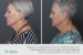 Ear Correction Surgery Before and After Gallery - Dr Michael Kernohan